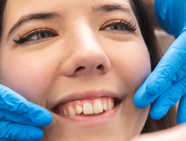 Self-ligating light force braces